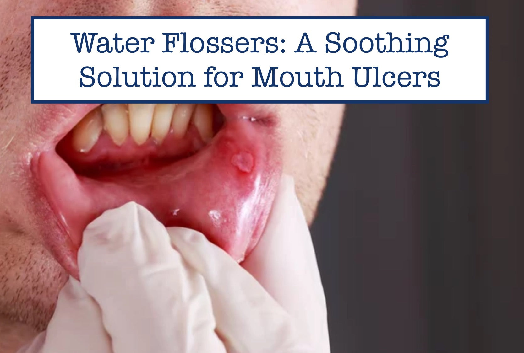 Water Flossers: A Soothing Solution for Mouth Ulcers – B.WEISS Health