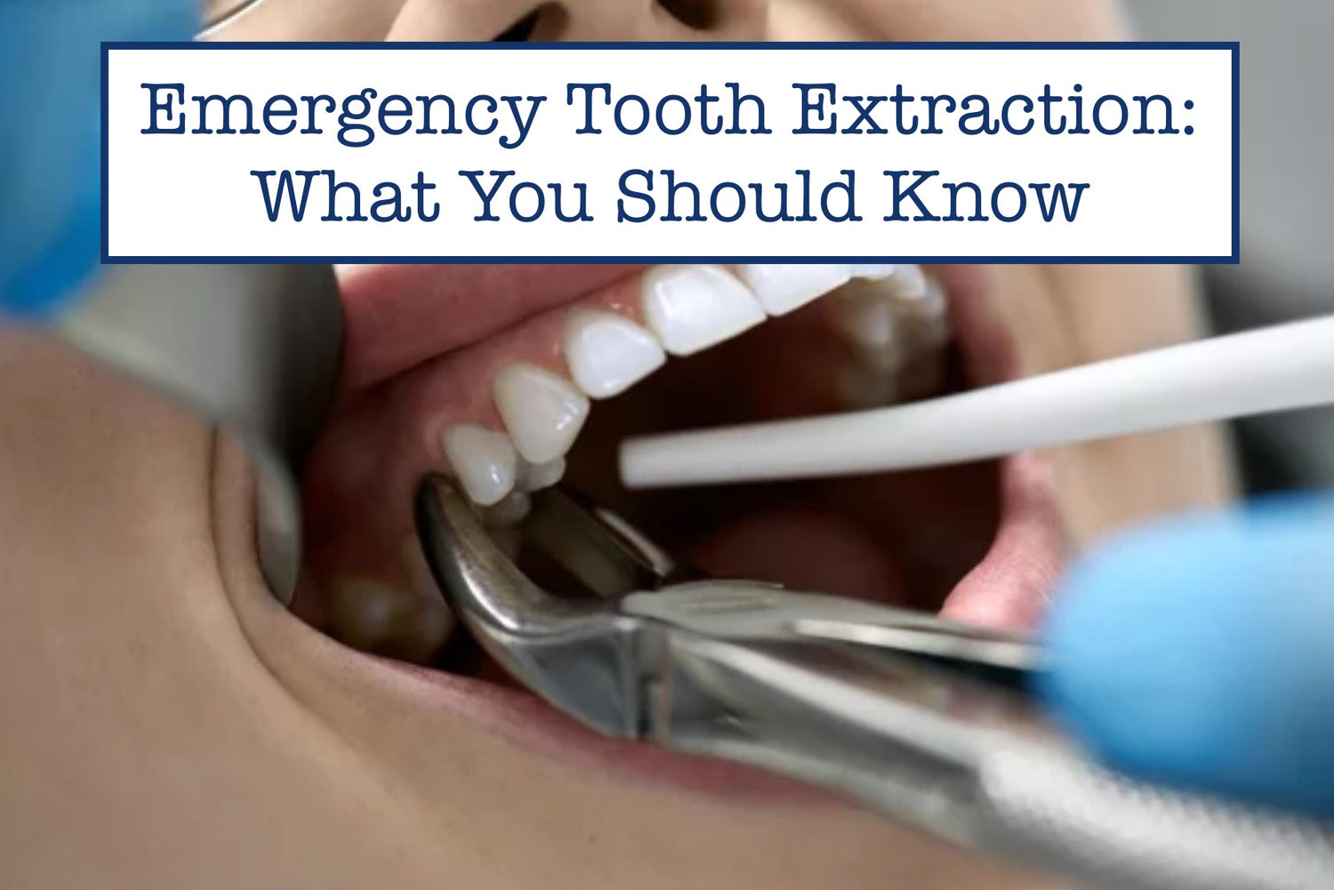 Emergency Tooth Extraction: What You Should Know – B.WEISS Health