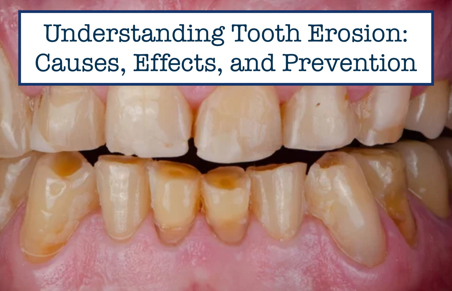 Understanding Tooth Erosion: Causes, Effects, and Prevention – B.WEISS Health