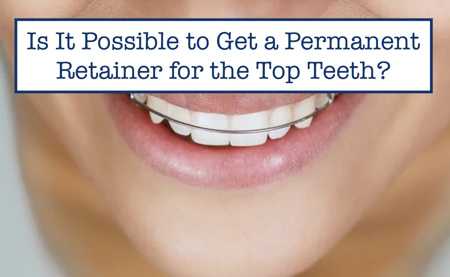Is a Permanent Retainer for Top Teeth Possible? – B.WEISS Health