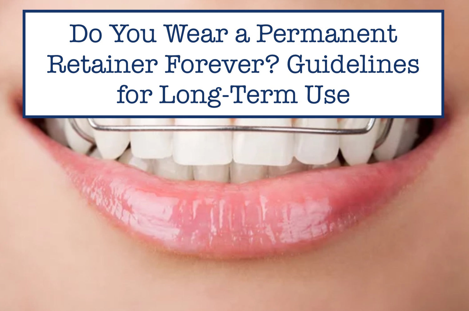 Do You Wear a Permanent Retainer Forever? The Shocking Truth! – B.WEISS ...