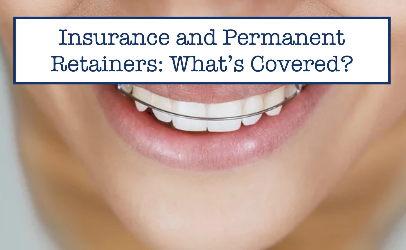 Insurance and Permanent Retainers: What’s Covered? – B.WEISS Health