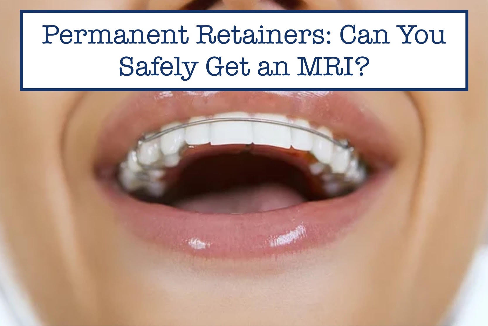 Permanent Retainers: Can You Safely Get an MRI? – B.WEISS Health