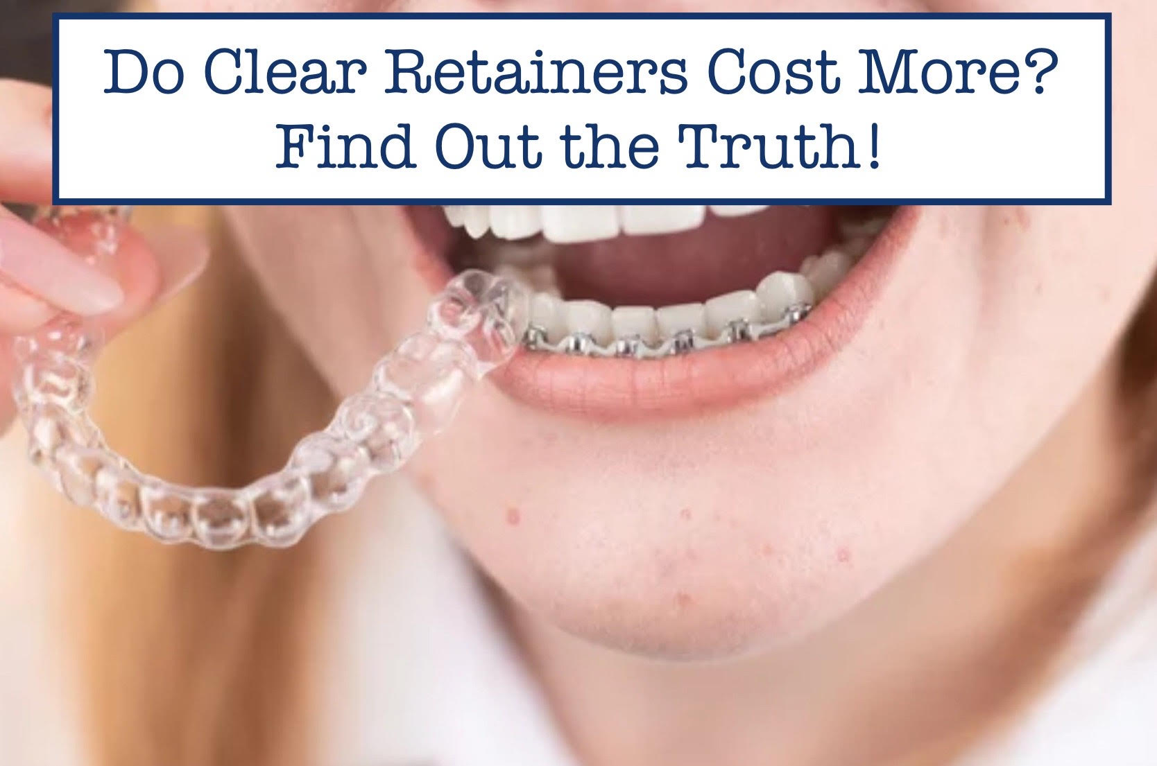 Do Clear Retainers Cost More? Find Out the Truth! – B.WEISS Health