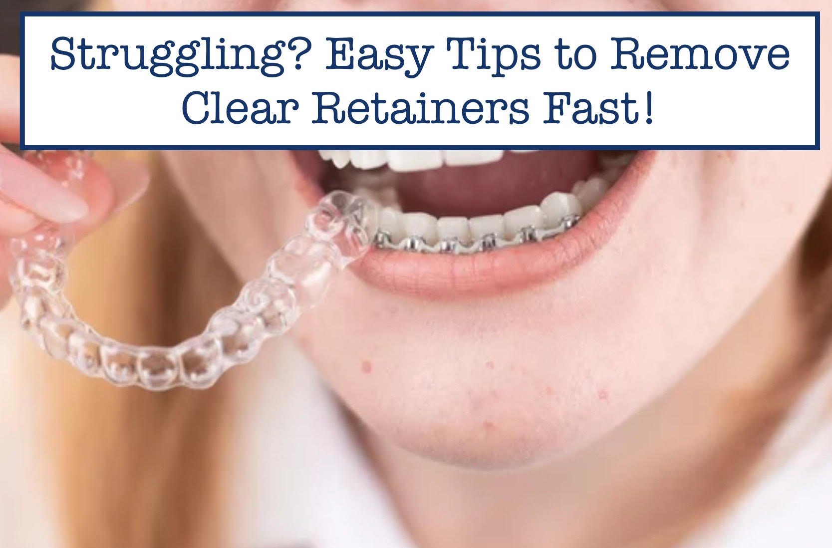 Struggling? Easy Tips to Remove Clear Retainers Fast! – B.WEISS Health