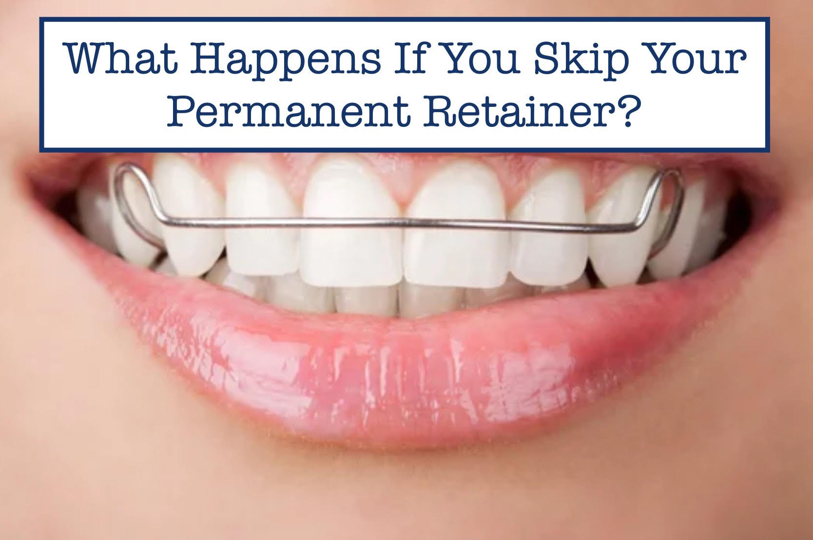 What Happens If You Skip Your Permanent Retainer? – B.WEISS Health