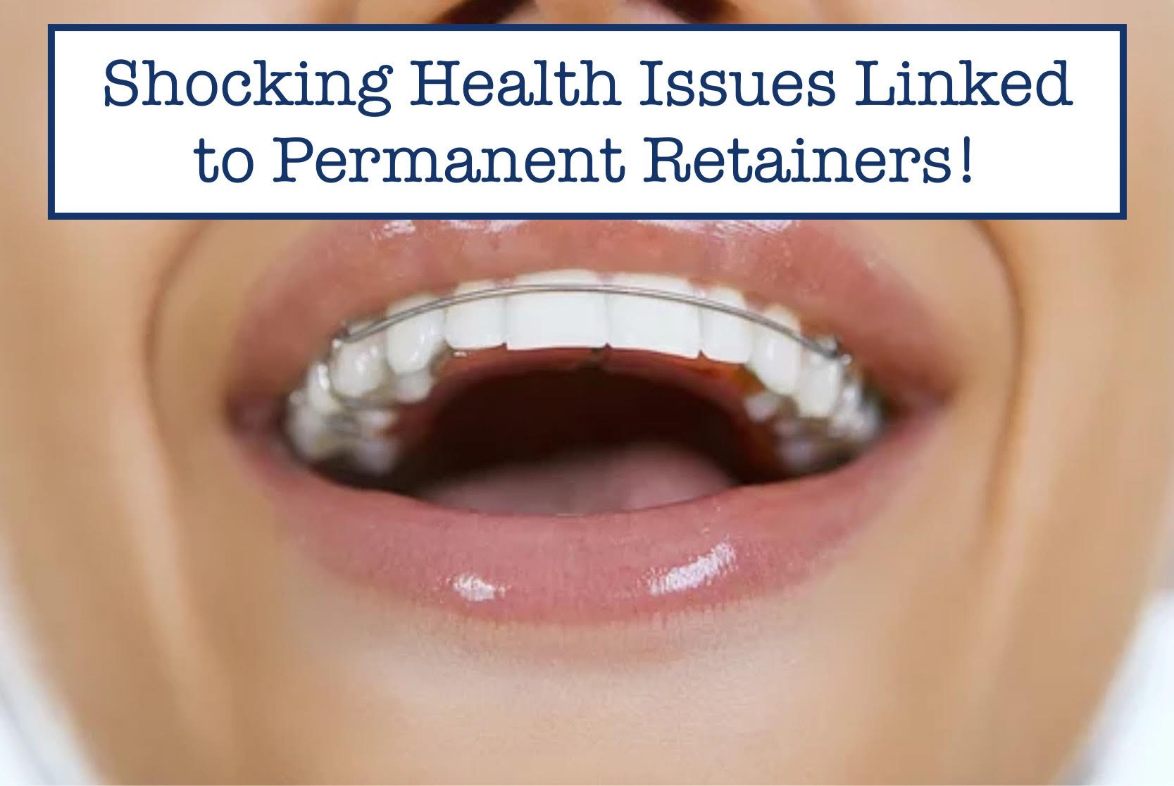 Shocking Health Issues Linked to Permanent Retainers! – B.WEISS Health