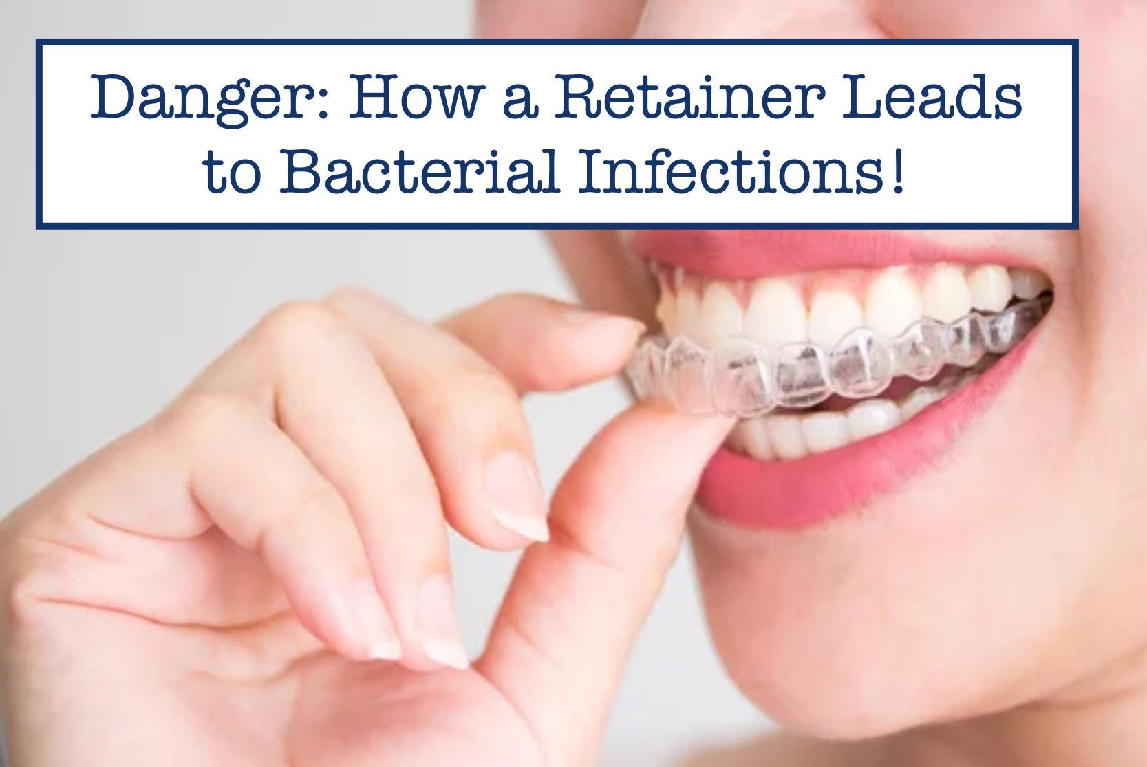Danger: How a Retainer Leads to Bacterial Infections! – B.WEISS Health