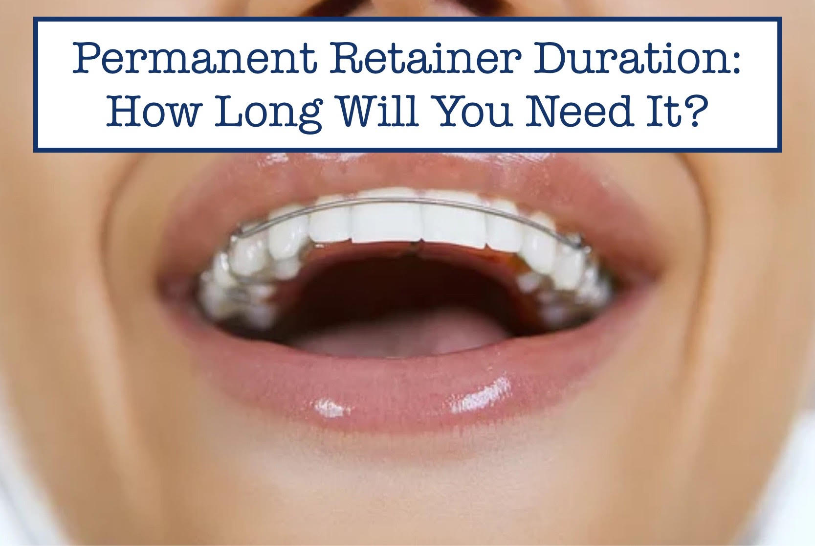 Permanent Retainer Duration: How Long Will You Need It? – B.WEISS Health