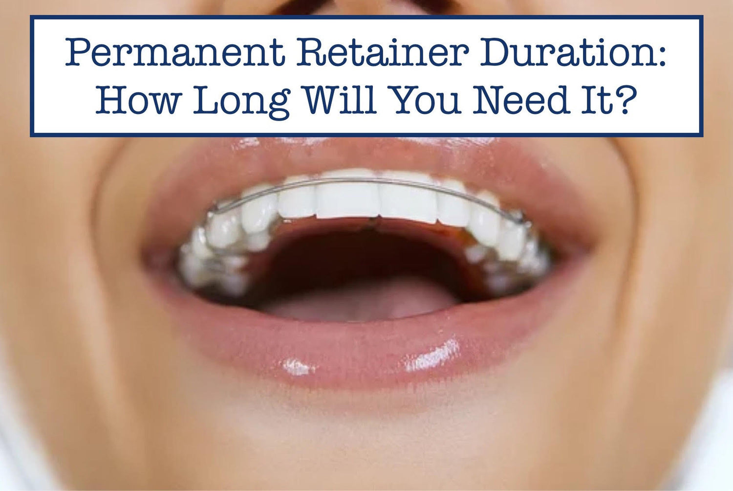 Permanent Retainer Duration: How Long Will You Need It? – B.WEISS Health