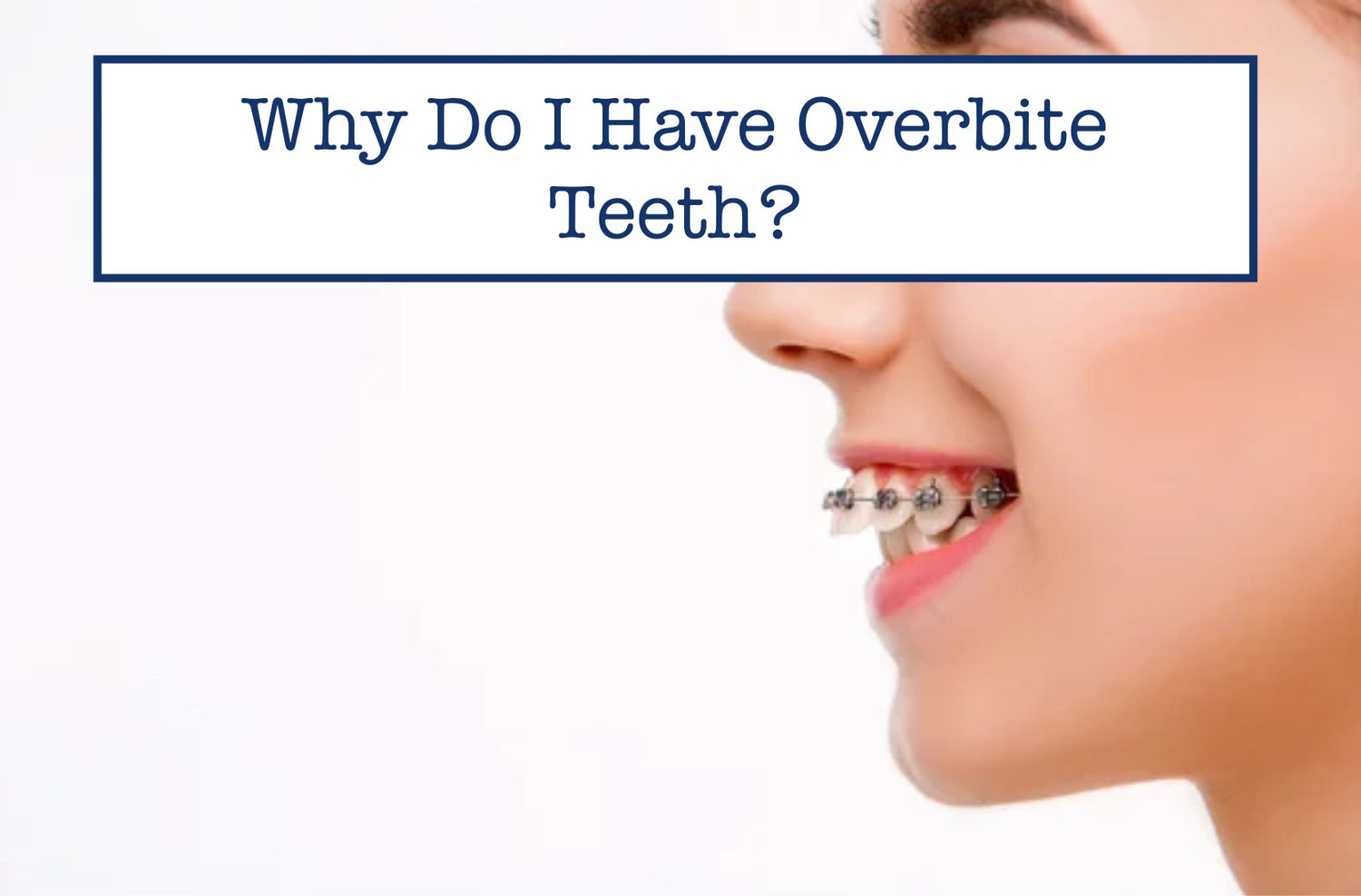 Why Do I Have Overbite Teeth? – B.WEISS Health