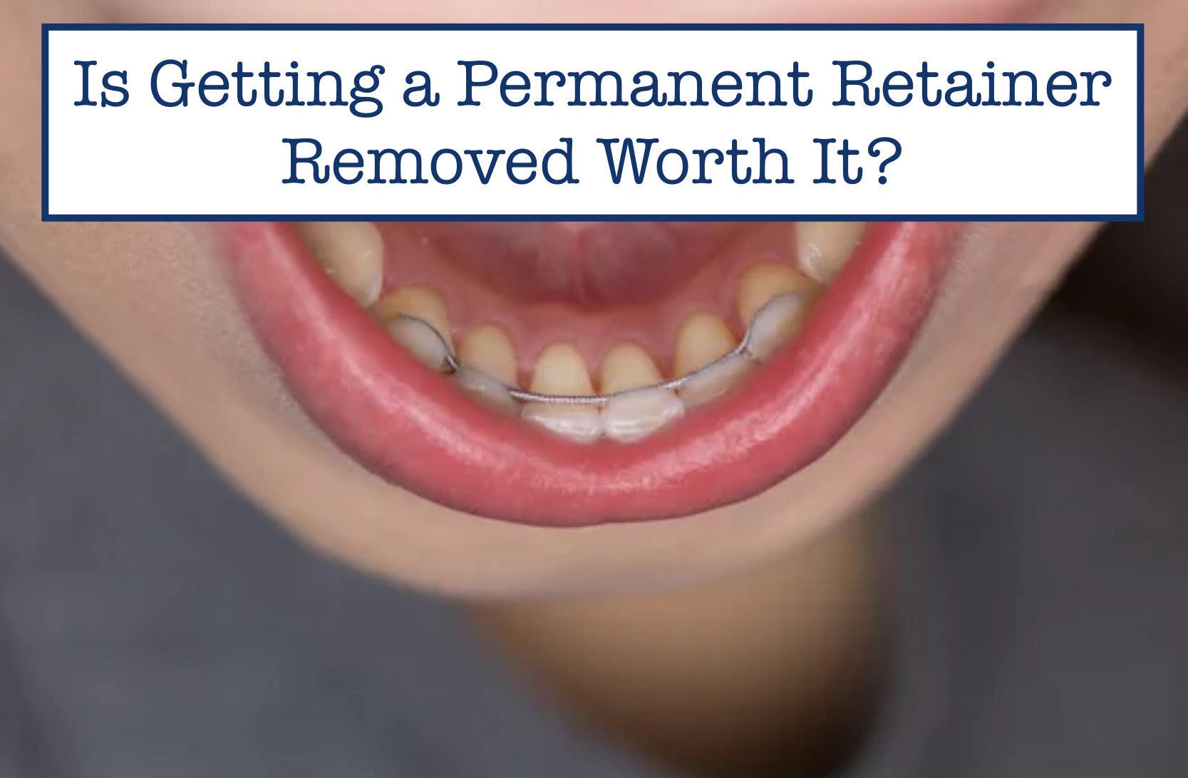 Is Getting a Permanent Retainer Removed Worth It? – B.WEISS Water Flosser