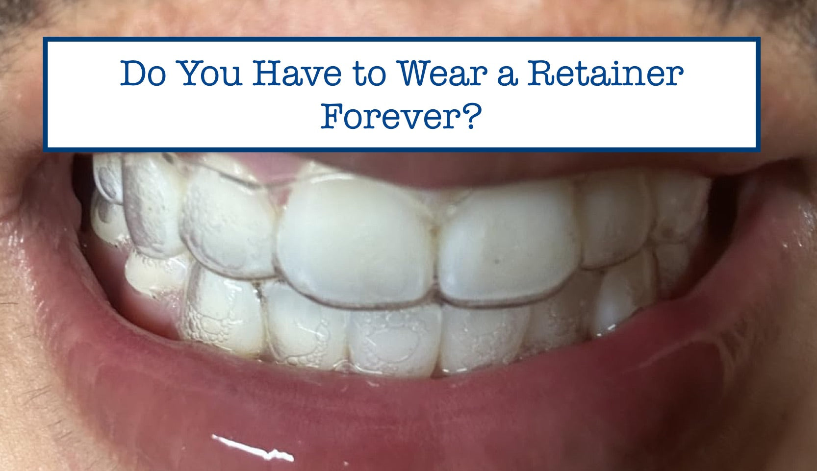 Do You Have to Wear a Retainer Forever? – B.WEISS Health