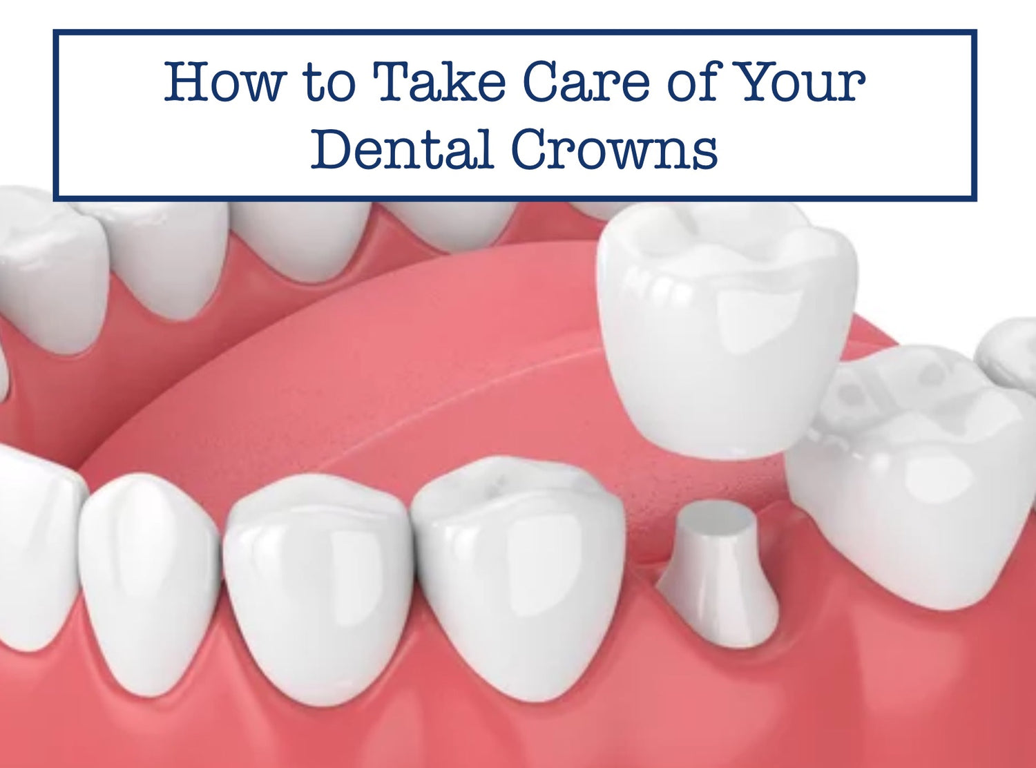 How to Take Care of Your Dental Crowns – B.WEISS Health