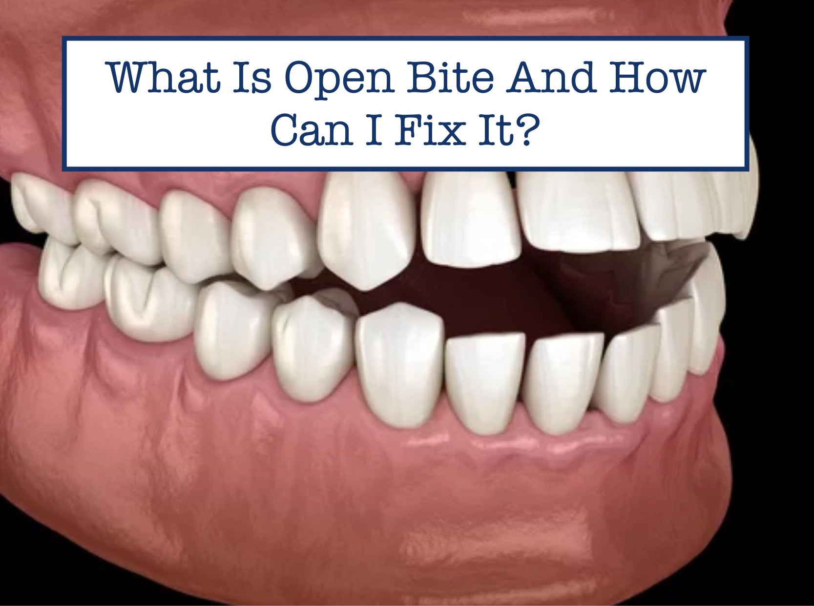 What Is Open Bite And How Can I Fix It? – B.WEISS Health