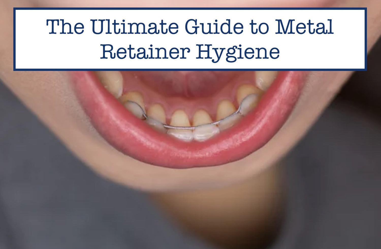 The Ultimate Guide to Metal Retainer Hygiene – B.WEISS Health