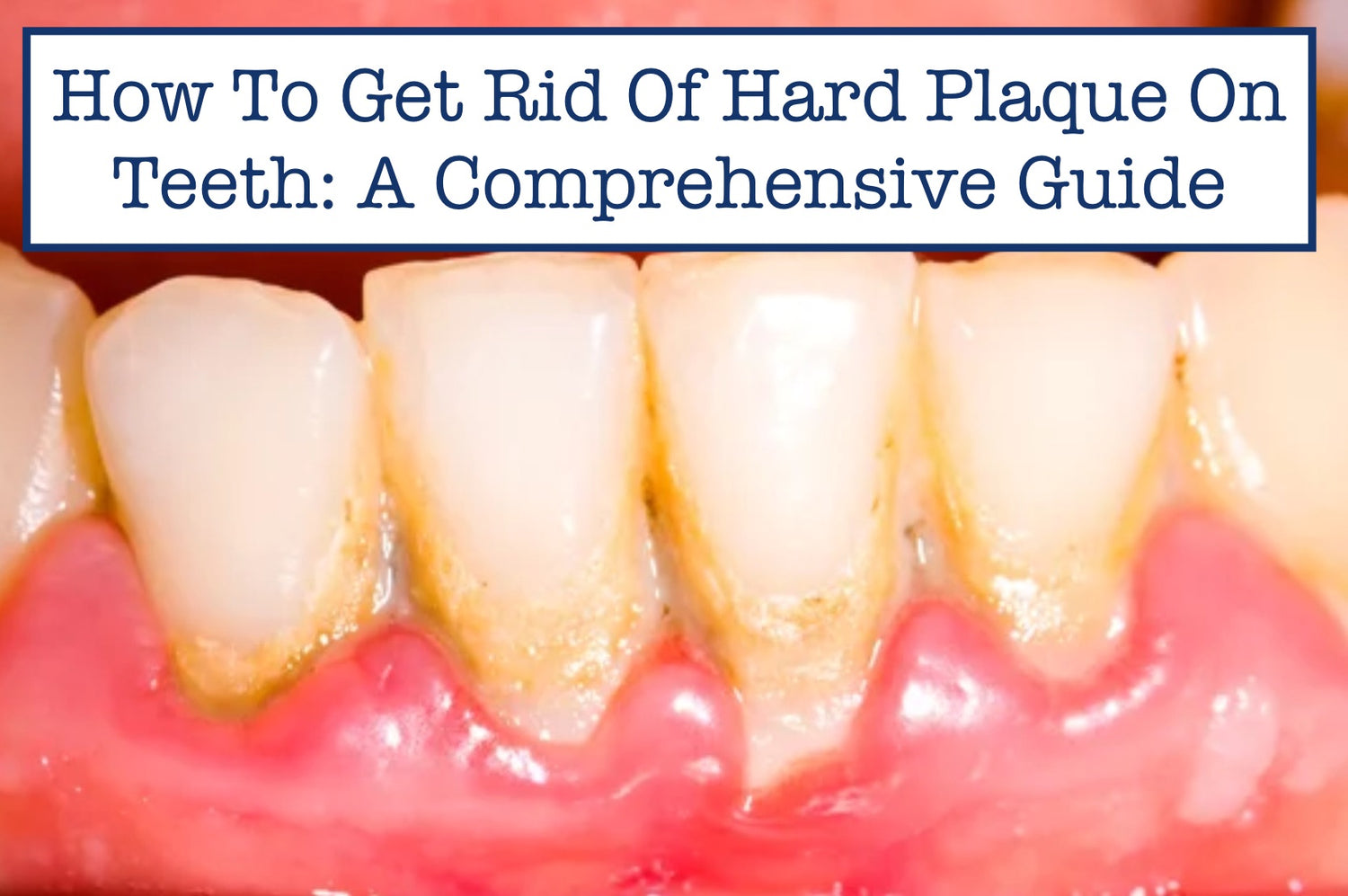How To Get Rid Of Hard Plaque On Teeth: A Comprehensive Guide – B.WEISS ...