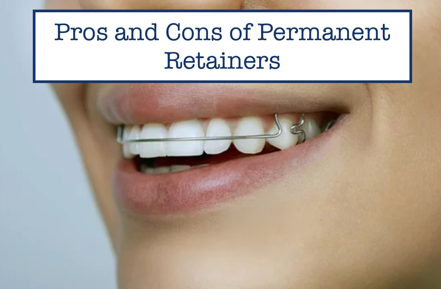 Pros and Cons of Permanent Retainers – B.WEISS Health