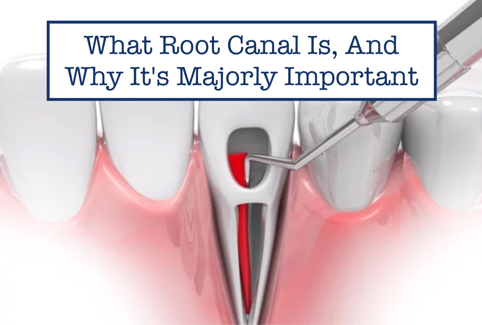 What Root Canal Is, And Why It's Majorly Important – B.WEISS Health