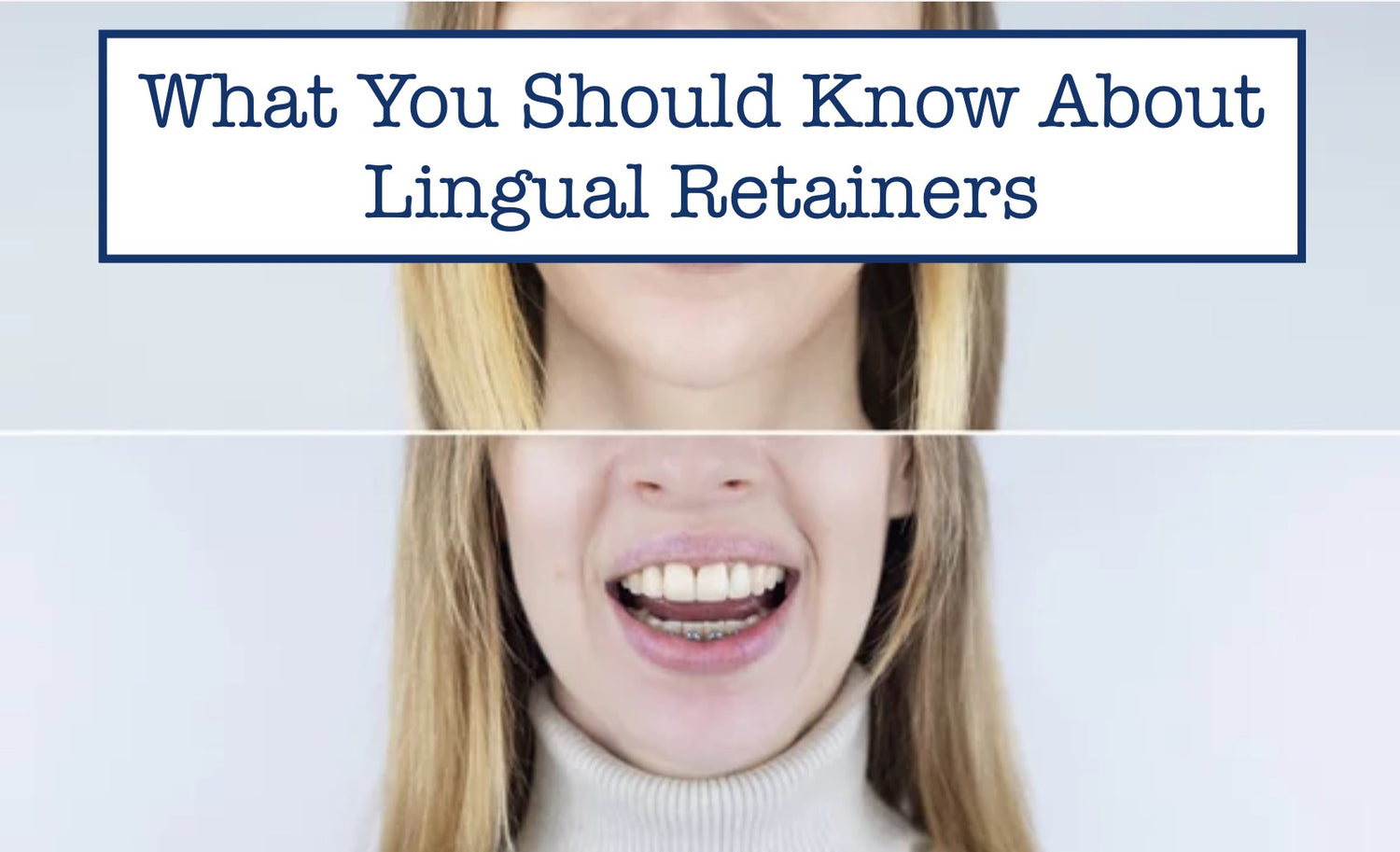 What You Should Know About Lingual Retainers – B.WEISS Health