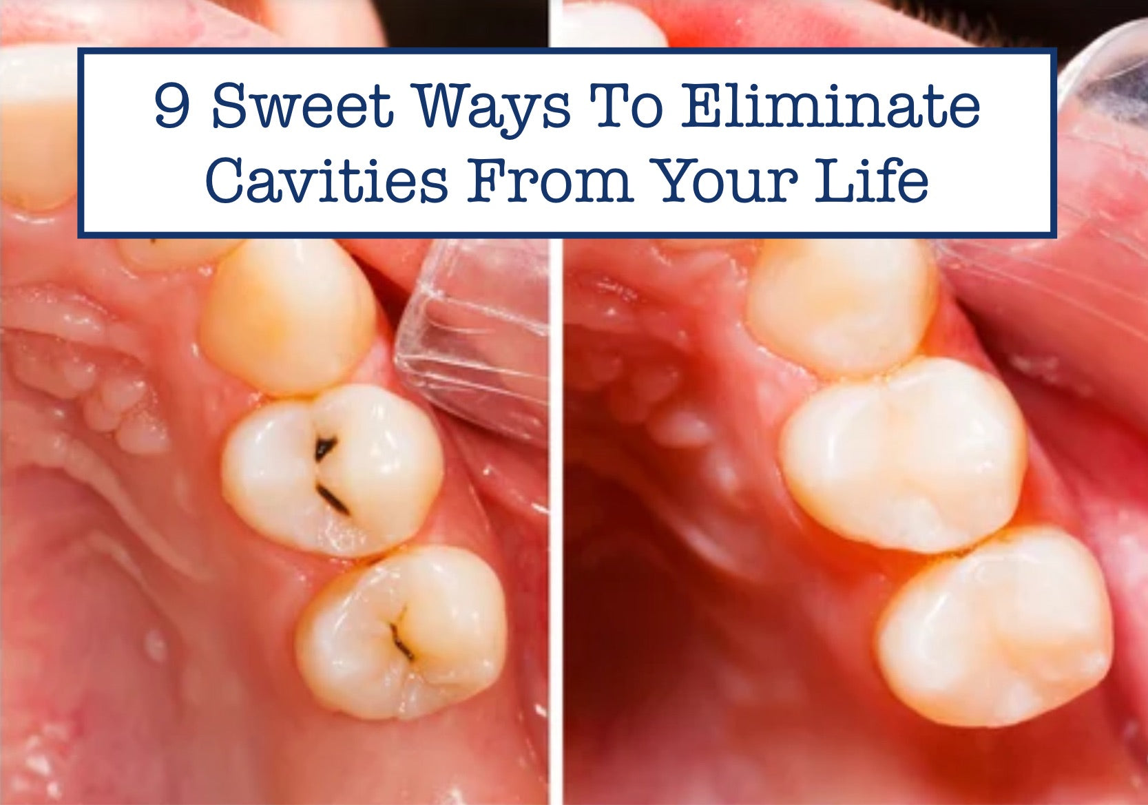 9 Sweet Ways To Eliminate Cavities From Your Life – B.WEISS Health